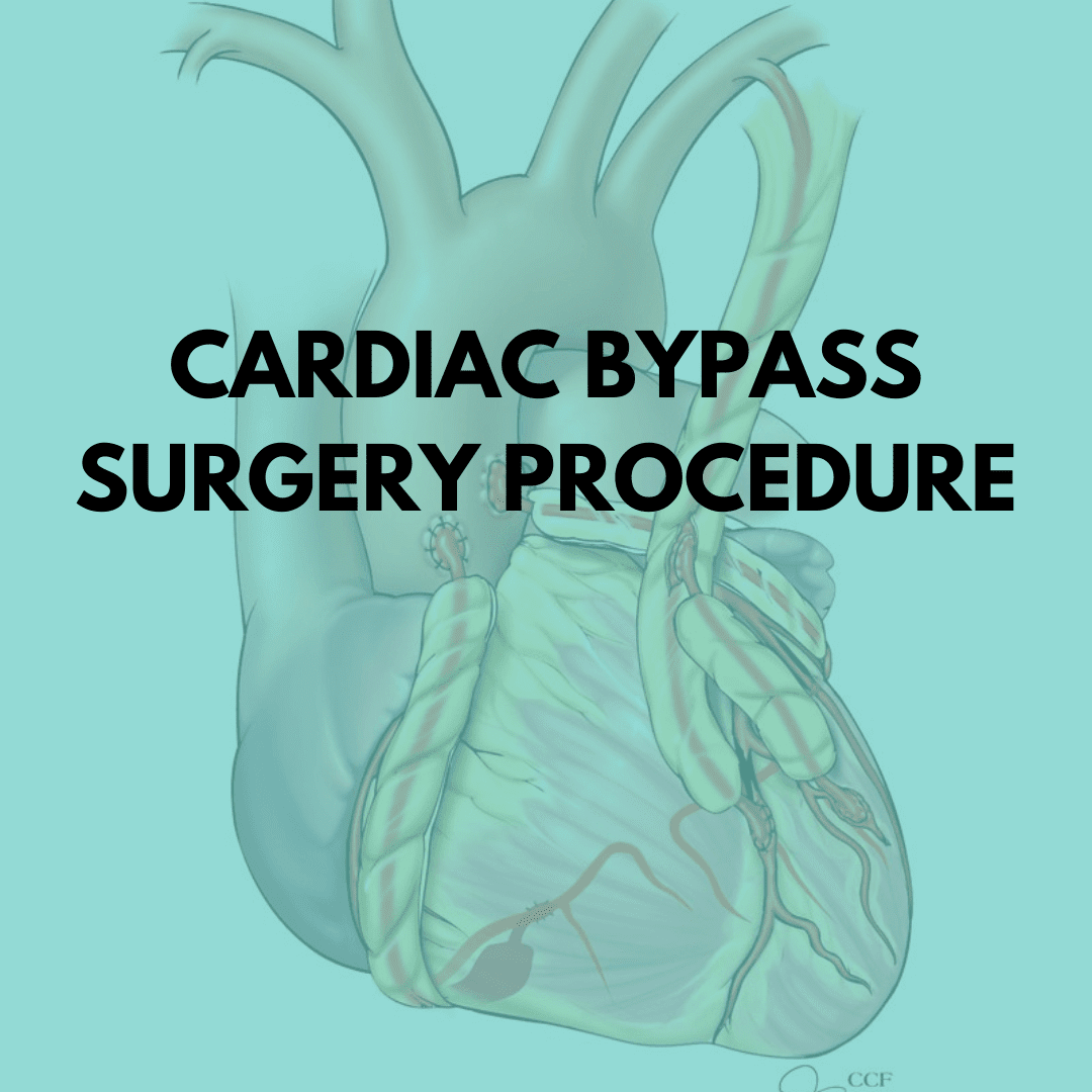 Cardiac Bypass Surgery Procedure