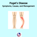 Paget’s disease- symptoms, causes, and management > Niruja HealthTech