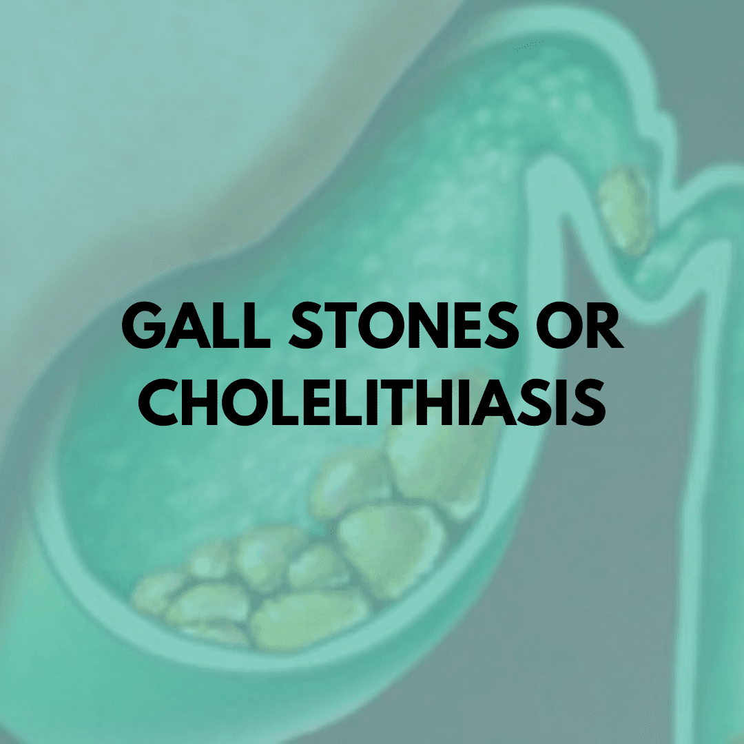 Gall stones or cholelithiasis
