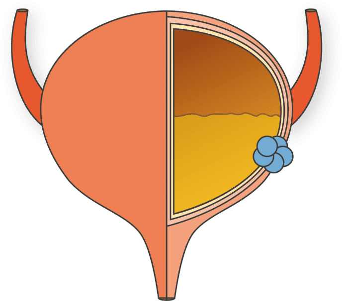 Bladder Cancer Types: Infographic