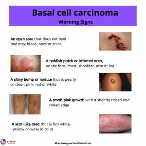 Basal Cell Carcinoma