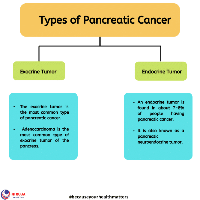 Types Of Pancreatic Cancer Types Of Pancreatic Cancer