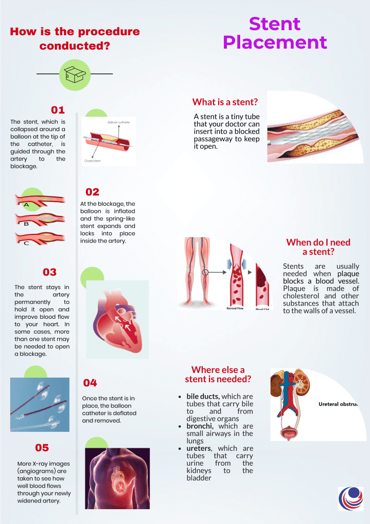 Coronary Artery Stent Placement How Long Does A Coronary Stent Stay In