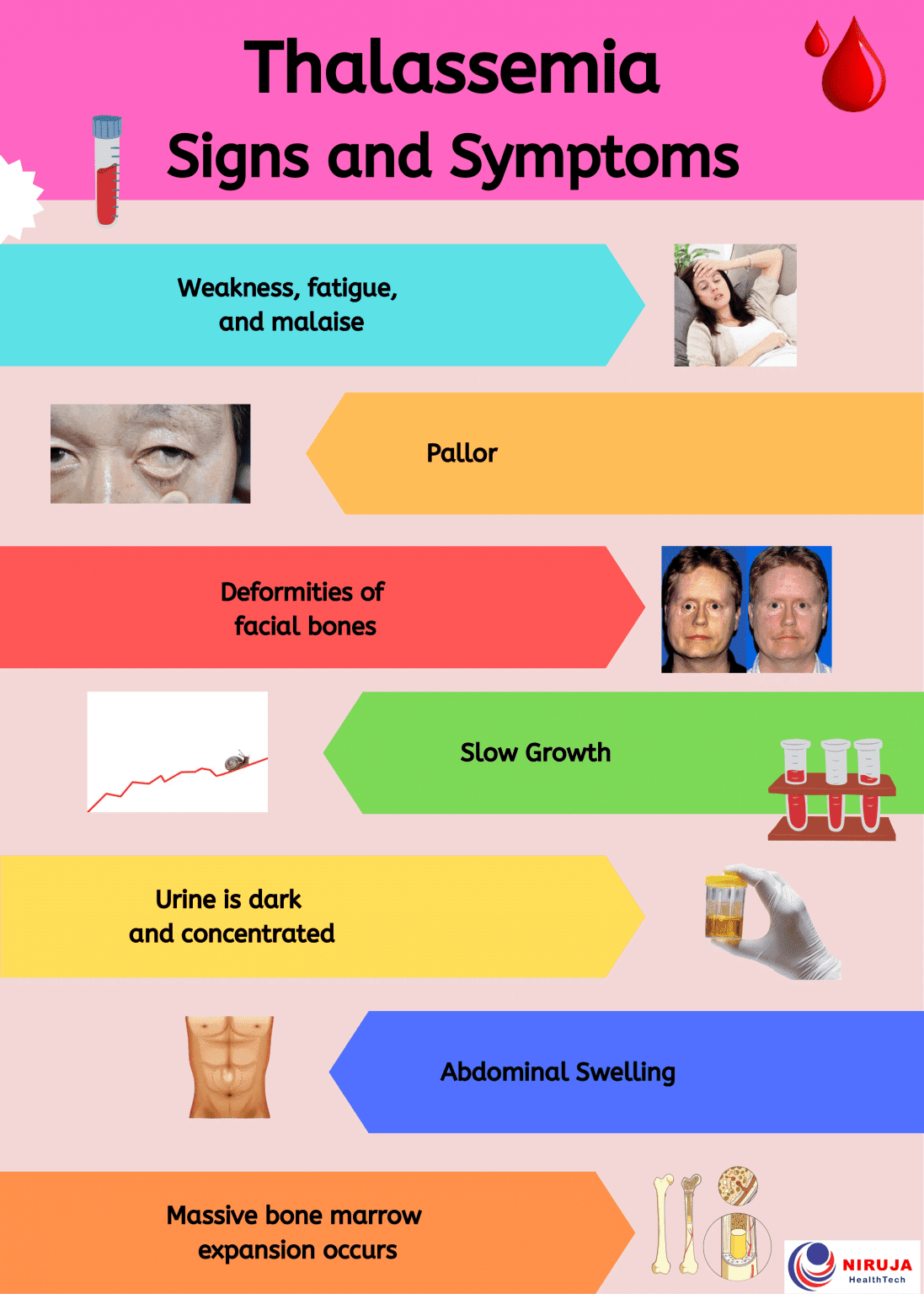 Thalassemia: Signs and Symptoms