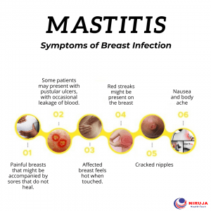 Mastitis: Symptoms of Breast Infection